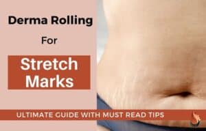 Derma Rolling For Stretch Marks - Ultimate Guide - Sasily Skin