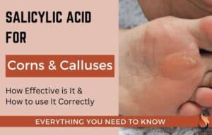 Salicylic Acid for Calluses & Corns: What You Need to Know - Sasily Skin