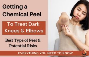 5 Best Creams to Lighten Dark Knees & Elbows - Sasily Skin